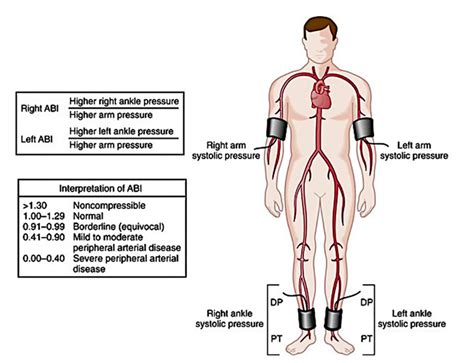 Ankle Brachial Index More Than A Diagnostic Test Pmc