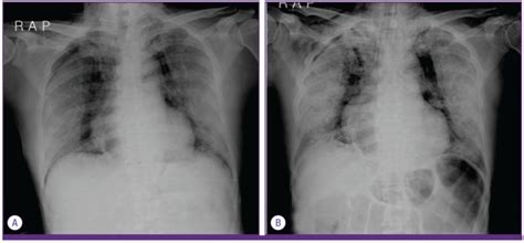 Chest Radiography Showing Newly Developed Pneumomediastinum And