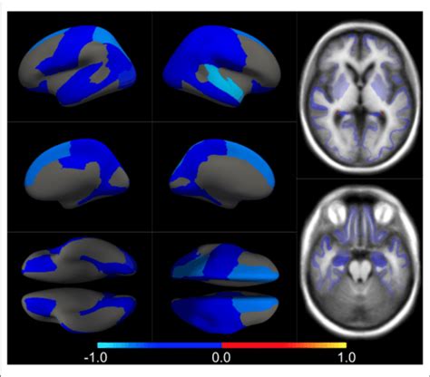 Different Views Of The Multivariate Brain Morphometric Effect Of Age