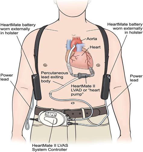 Jarvik 2000 Lvad