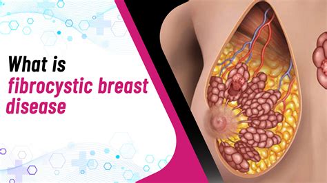 What Is Fibrocystic Breast Disease Causes Symptoms Diagnosis