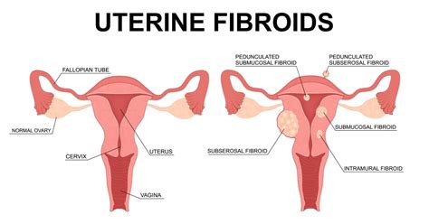 What Is The Difference Between Fibroids And Ovarian Cysts AFC
