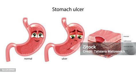 Stomach Ulcers Cute Happy And Sad Stomach Characters With Faces Stomach