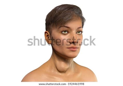 갑상선 종양 갑상선 안에서의 복절을 보여주는 스톡 일러스트 1924461998 Shutterstock