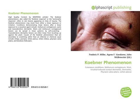 Koebner Phenomenon 978 613 3 92528 1 6133925280 9786133925281