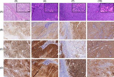 Morphological Immunohistochemical And Molecular Analysis Of Follicular Dendritic Cell Sarcomas