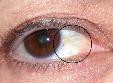 Pinguecula Warwar Eye Group