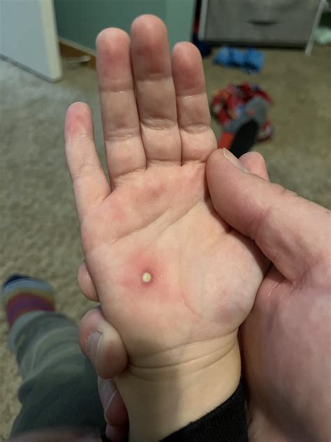 Does This Look Like A Wart Or Bug Bite Or What On 4 Yo Son Rwarts