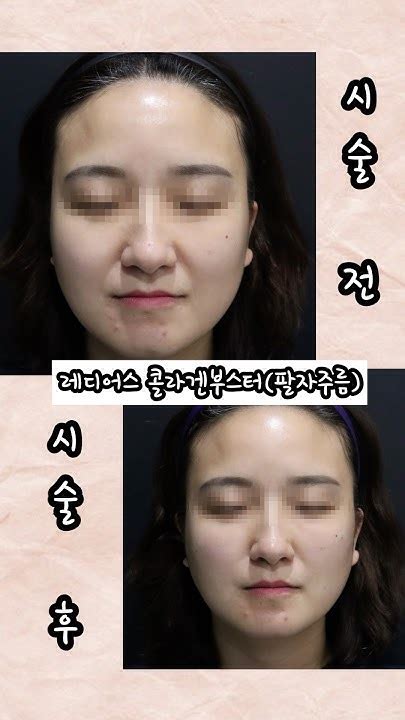 팔자주름 없애는 피부시술레디어스 콜라겐부스터 Youtube