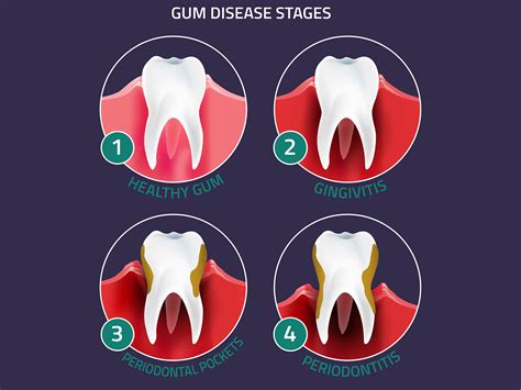 Difference Between Gingivitis And Gum Disease