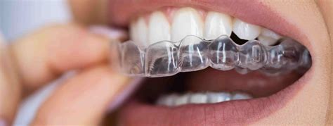 A Comprehensive Guide To How Braces Work Metal Invisible Ceramic