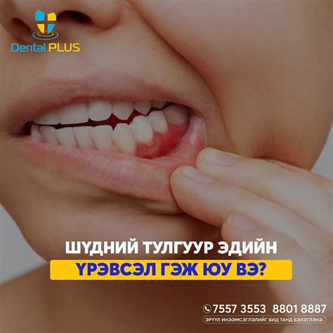 БХандсүрэн Энэ нь шүд сулрах өвчин буюу буйлны үрэвслээс үүдэлтэй