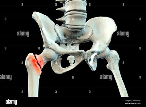 Illustration Of A Basicervical Femur Fracture Showing A Break At The