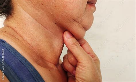 Portrait The Fingers Holding The Flabbiness Adipose Sagging Skin