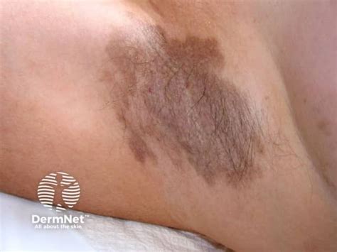 Acquired Dermal Macular Hyperpigmentation Image