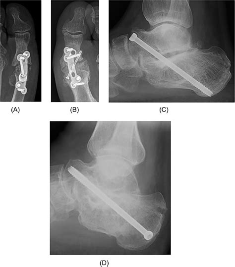 The Effects Of Nsaids On Foot And Ankle Arthrodesis Procedures A Retrospective Chart Review