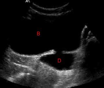 Urethral Diverticulum Ultrasound Case Report Prostatic Urethral