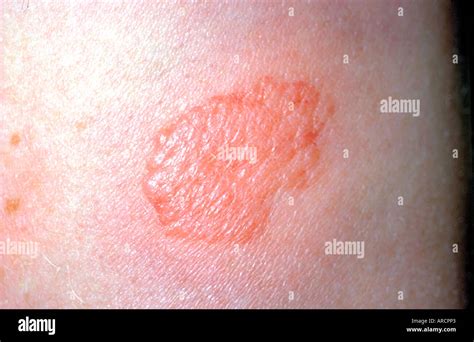 A Photograph Of A Reaction To The Tuberculin Skin Test Called A