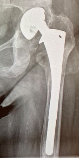 Depuy Synthes Aml Older Hip Implant Identifier”