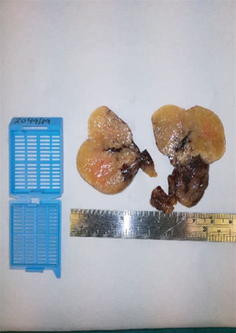 A B Macroscopic View Of The Inflamed Epiploic Appendix After Download Scientific Diagram