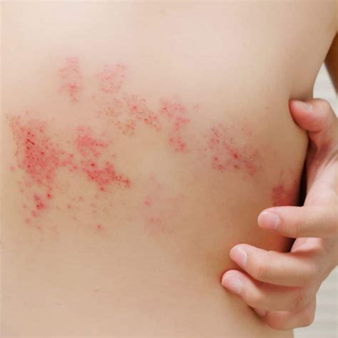 Make An Appointment With A Shingles Doctor In Nashville Advanced Skin And Laser Center