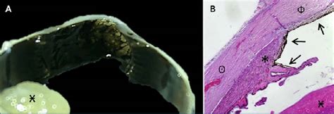A Macroscopic Section Showing Corneal Thickening And Anterior Chamber