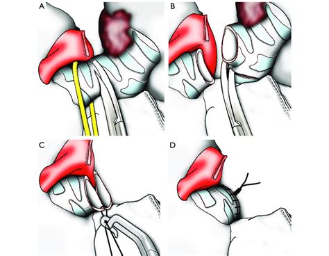 Drawing Showing The Sequence Of Lower Lobe Sleeve Resection And