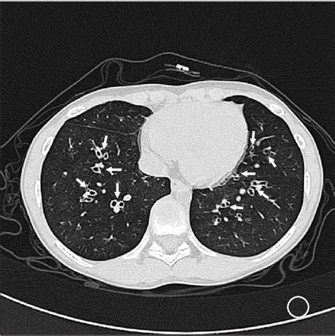 Pre Surgery Hrct Diffuse Bronchial Dilatation With Bronchial Wall
