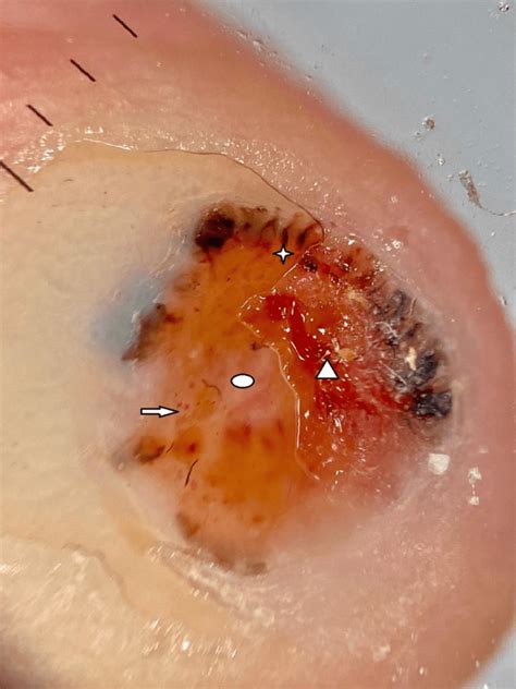 Basosquamous Carcinoma A Rare Entity With An Atypical Presentation Pmc