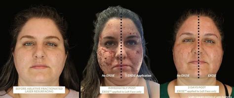 Exo E® Skin Revitalizing Complex Treatment Adam And Eve Medical Aesthetics Medical Spa