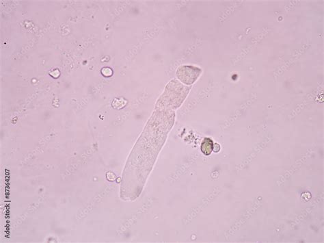 Hyaline Cast In Urine