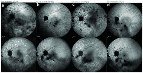 What Is Idiopathic Multifocal Choroiditis And How To Manage It Obn