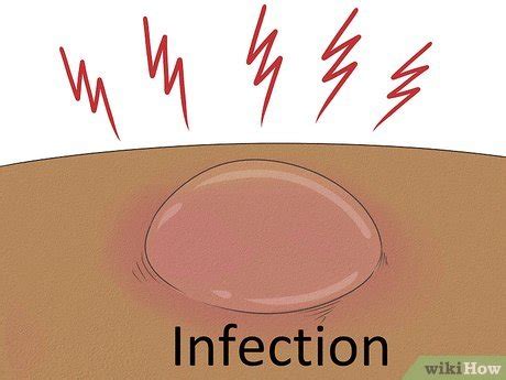 Pop A Blister When Its Safe And How To Do It