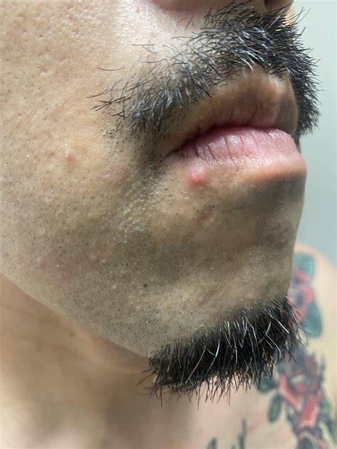 Pimple Or Cold Sore R Dermatologyquestions
