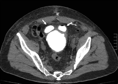 A Ct Cystography Post Filling Of The Bladder With Contrast Showing Download Scientific