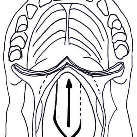 Two Soft Palate Flaps Used To Cover Raw Tissue Of Pharyngeal Flap Are Download Scientific