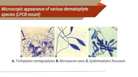 Fungal Infections Of Skin Soft Tissue Pptx Skin And Dermatology