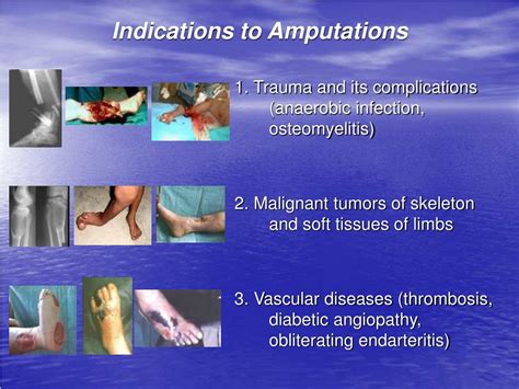 Ppt Indications To Amputations Powerpoint Presentation Free Download