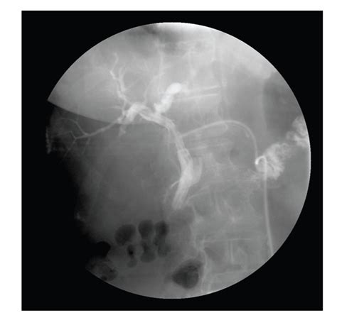 T Tube Cholangiogram Demonstrating Resolution Of The Stricture Download Scientific Diagram