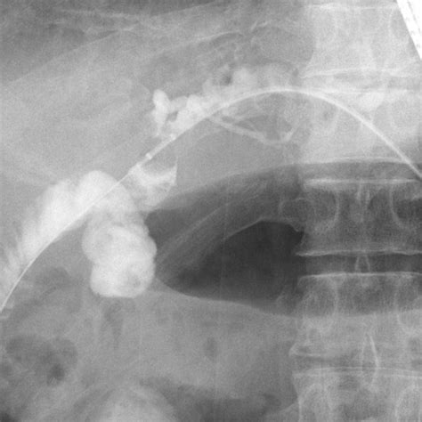 Schema Of Roux En Y Hepaticojejunostomy And Eus Guided Approach To The Download Scientific