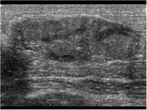 Breast And Axilla 51 Benign Lesions Case 518 Other Benign Non