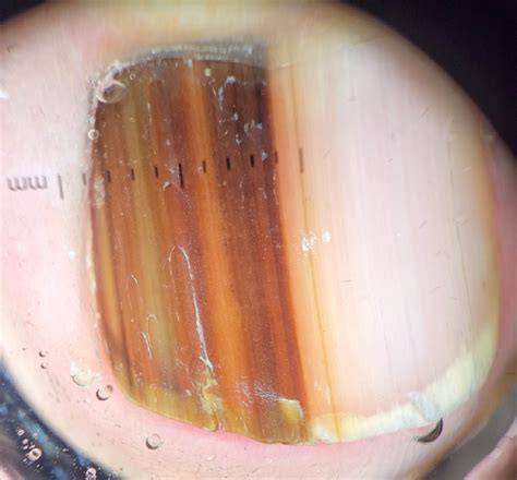 Pathology Outlines Normal Nail Grossing