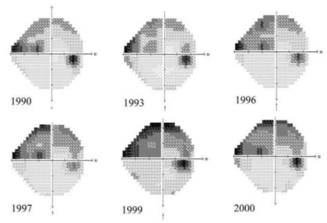Foresight Machine Learning Powered Glaucoma Detection