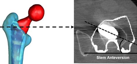 Measurement Of Postoperative Stem Anteversion The Postoperative Stem