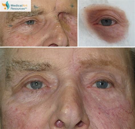 Orbital Prosthesis Photos Prosthetic Eye And Eyelids — Life Like