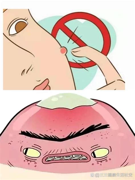 我的日常生活：关于火疖子的那些事儿