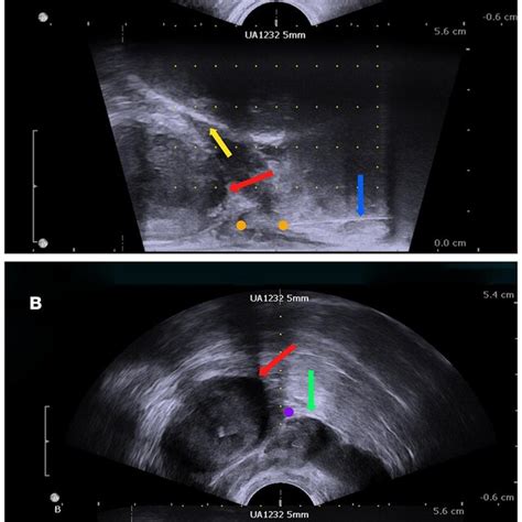 Diagram Of The Location Of The Perineal Nerve Block The 2 Grey Dots