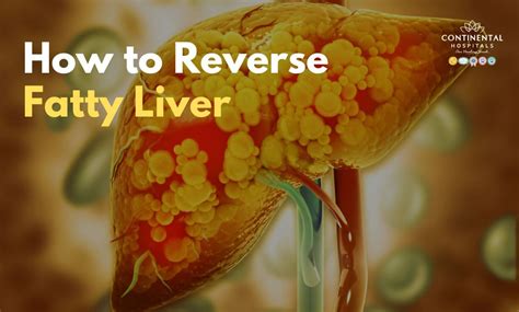 How To Reverse Fatty Liver