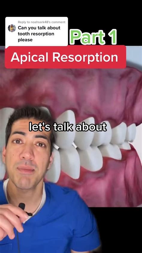 Part 1 Apical Resorption This Video Is About Tooth Reaoption