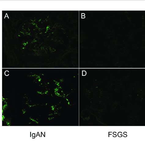 Glomerular Complement Factor Bb And C3c Deposits Were Detected In